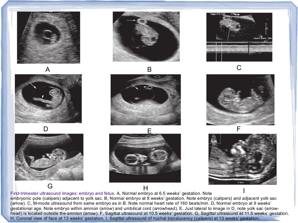 first trimester ultrasound and overview of obs imaging