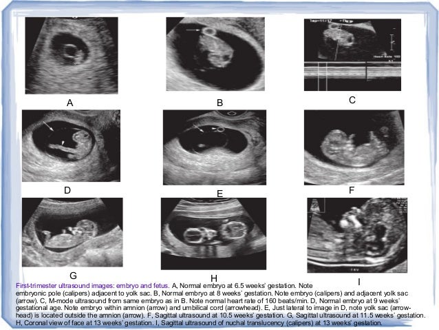 first trimester ultrasound and overview of obs imaging
