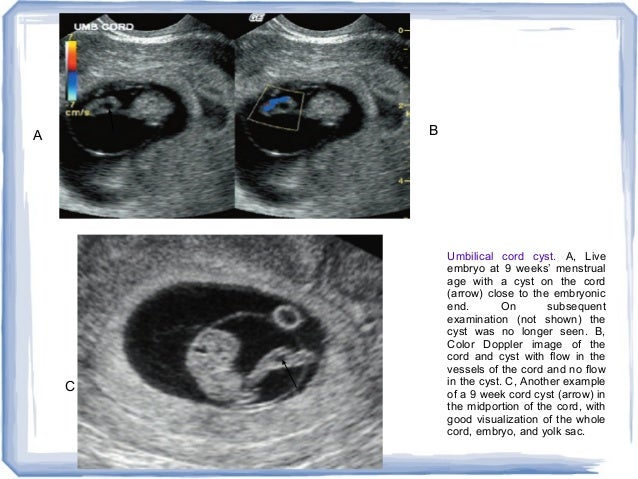 first trimester ultrasound and overview of obs imaging