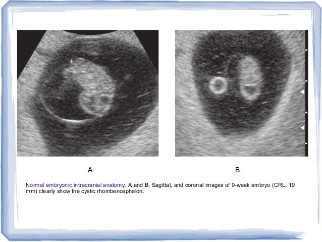Normal Early Pregnancy With Physiological Gut Herniation