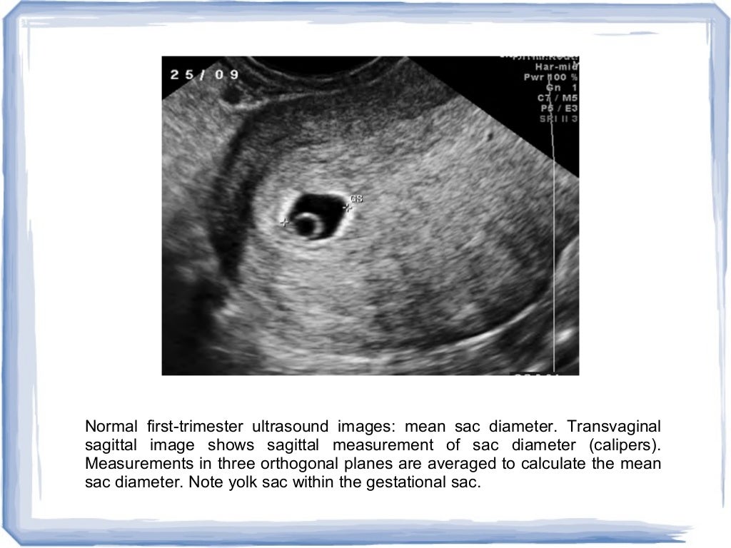 first trimester ultrasound and overview of obs imaging