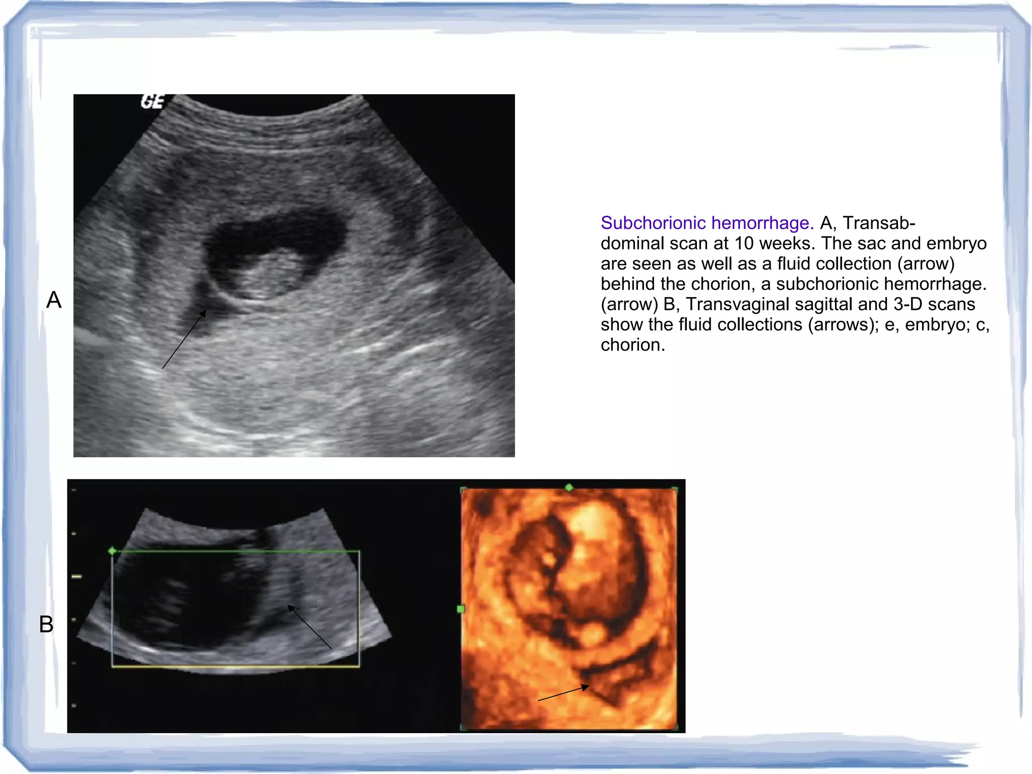 first trimester ultrasound and overview of obs imaging | PPT