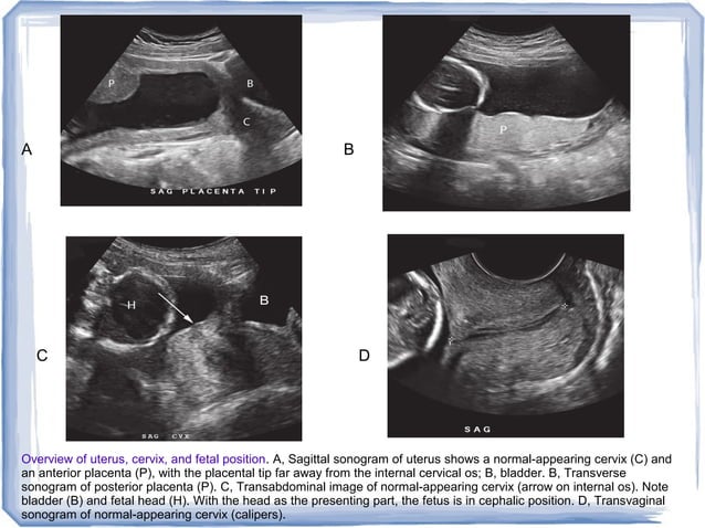 first trimester ultrasound and overview of obs imaging | PPT