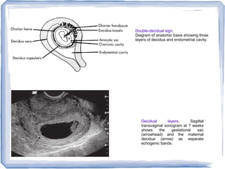 first trimester ultrasound and overview of obs imaging | PPT