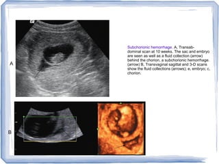 first trimester ultrasound and overview of obs imaging | PPT