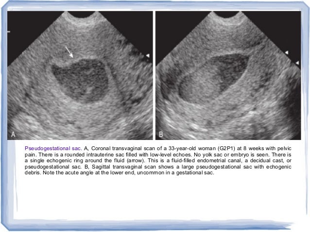 first trimester ultrasound and overview of obs imaging