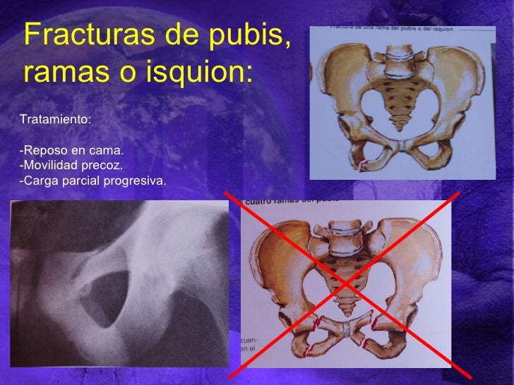 Fractura de pelvis