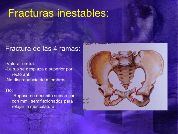 Fractura De Pelvis