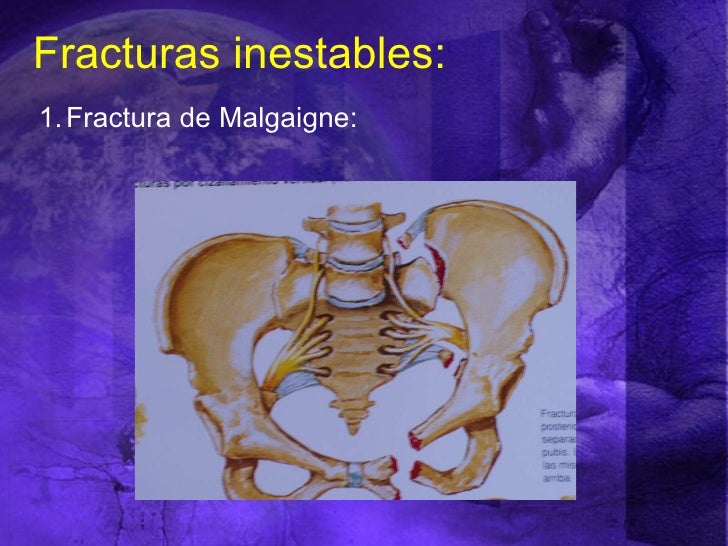 Fractura De Pelvis