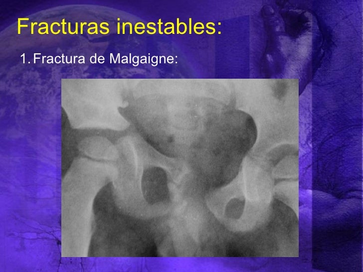 Fractura De Pelvis