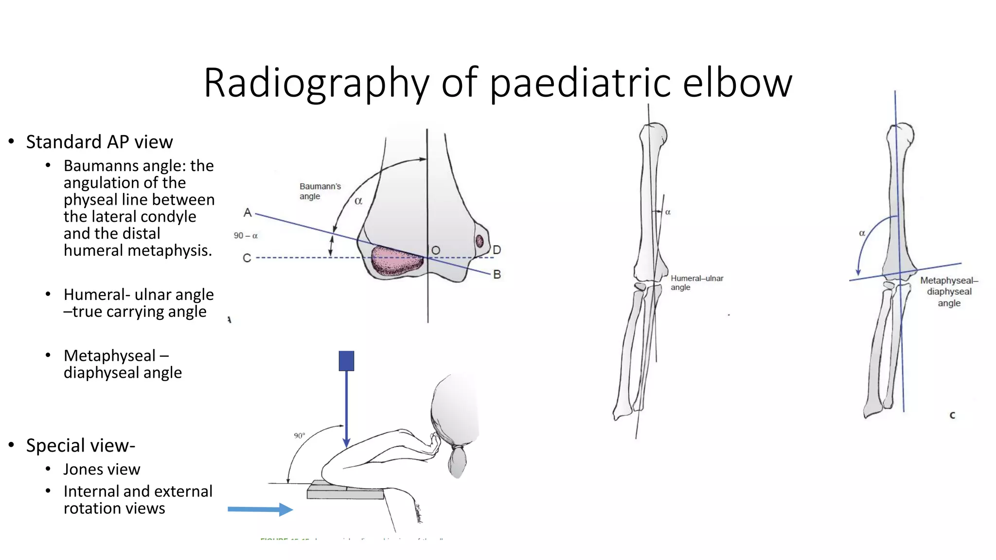 Fractures around elbow lateral condyle and intercondylar fractures | PDF