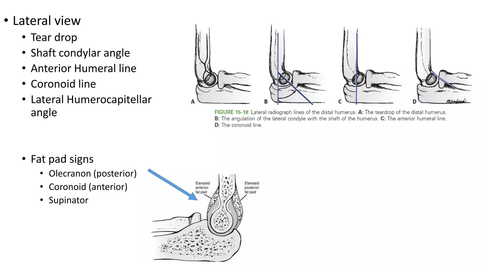 Fractures around elbow lateral condyle and intercondylar fractures | PDF