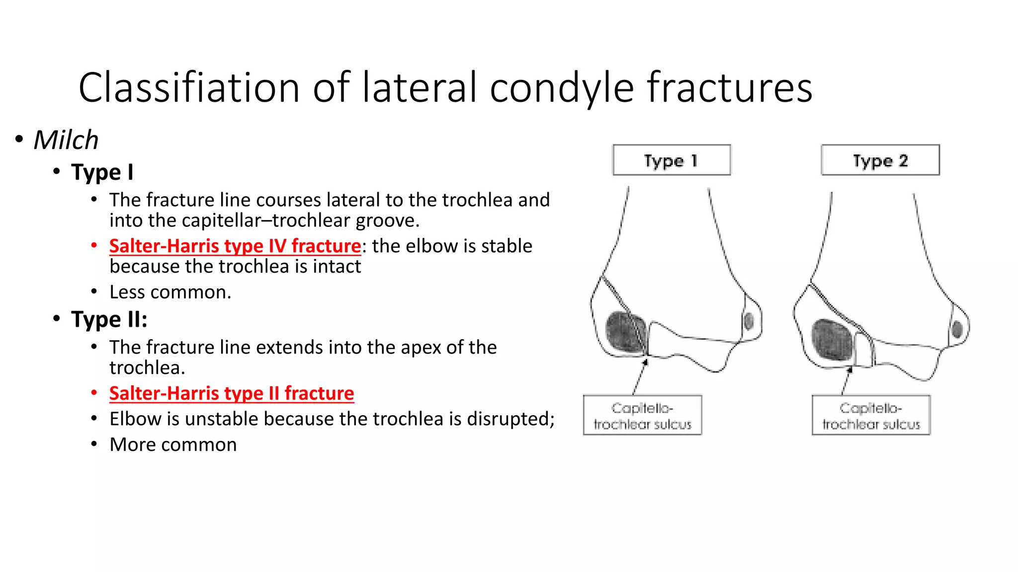 Fractures around elbow lateral condyle and intercondylar fractures | PDF