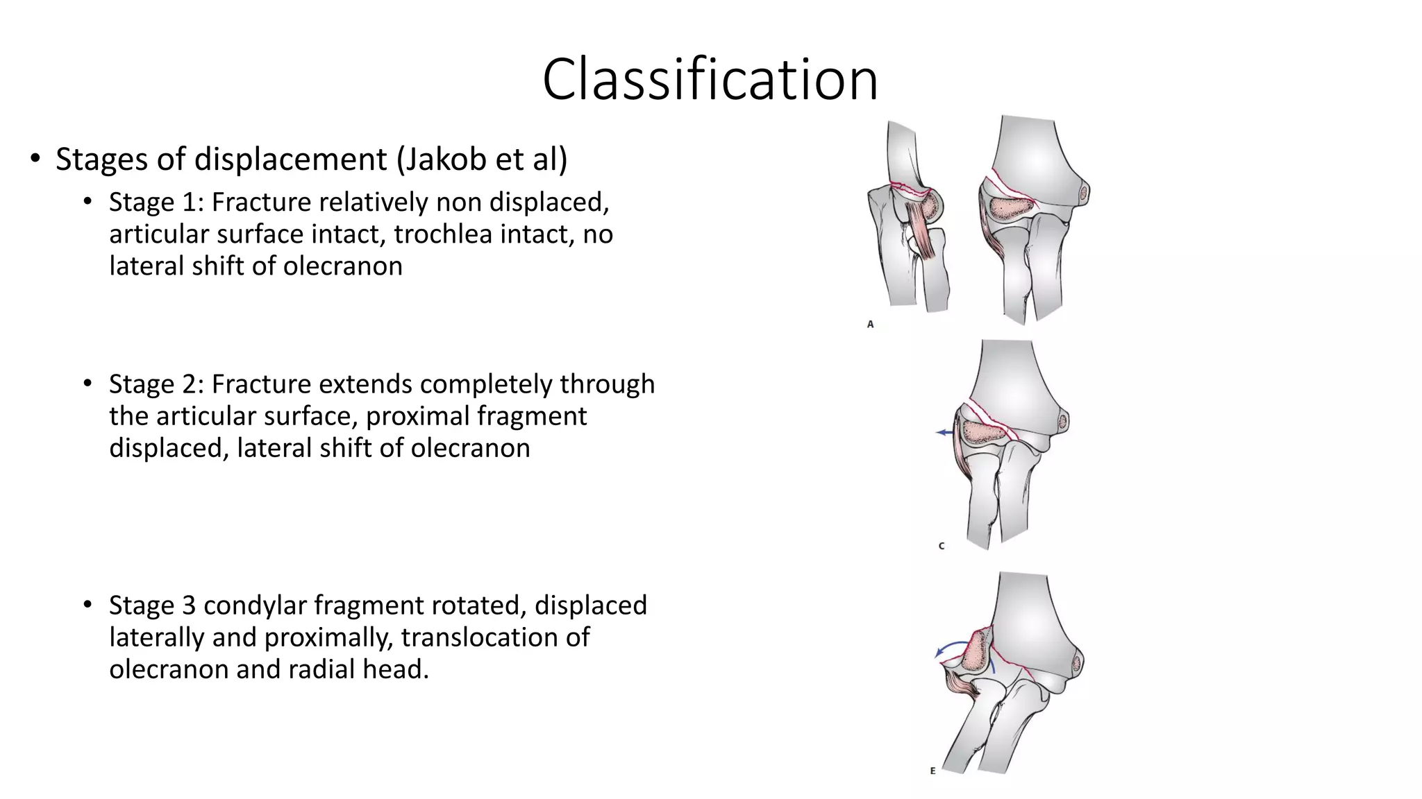 Fractures around elbow lateral condyle and intercondylar fractures | PPT