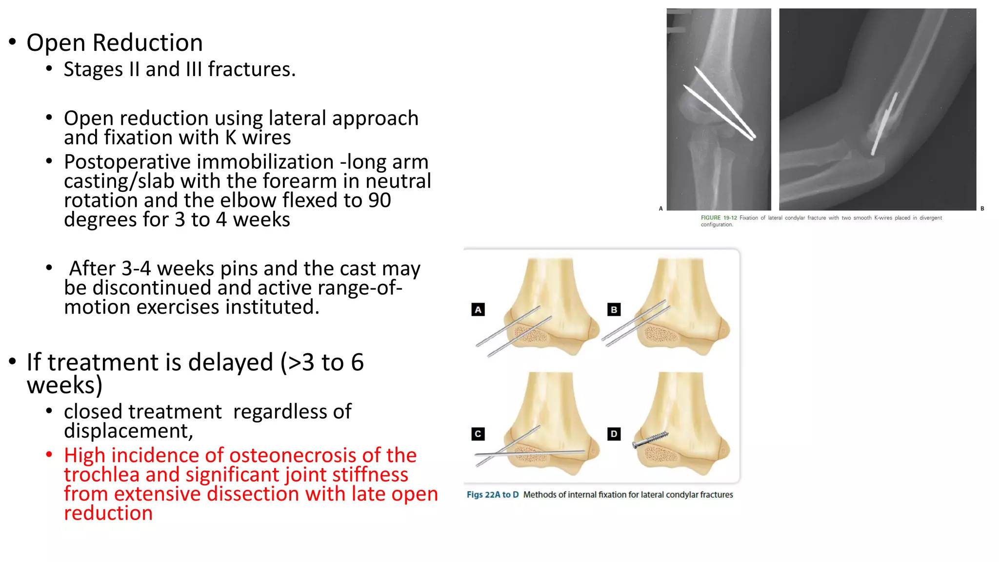 Fractures around elbow lateral condyle and intercondylar fractures | PDF