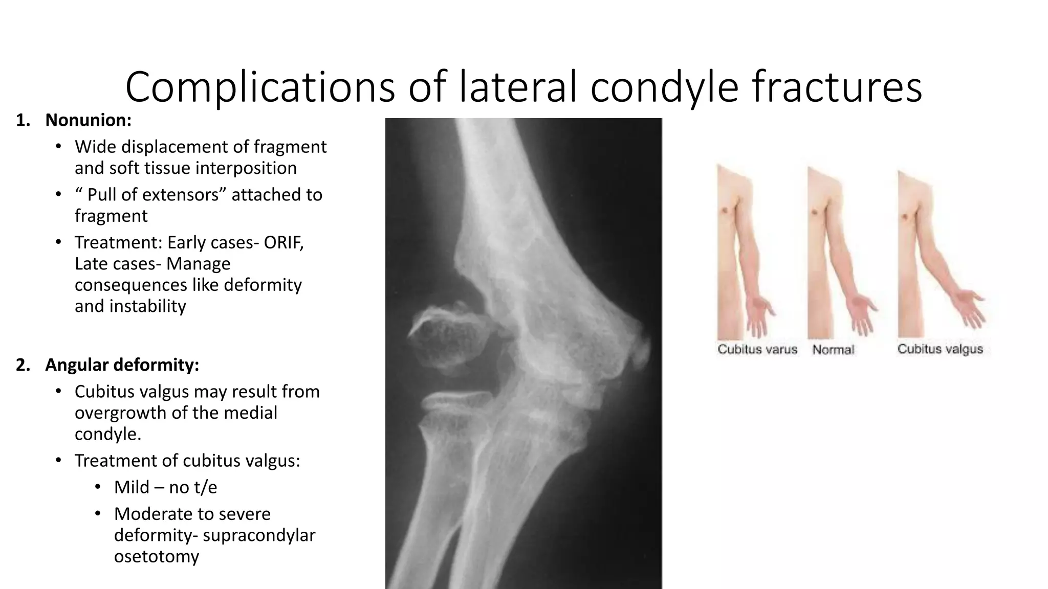 Fractures around elbow lateral condyle and intercondylar fractures | PDF