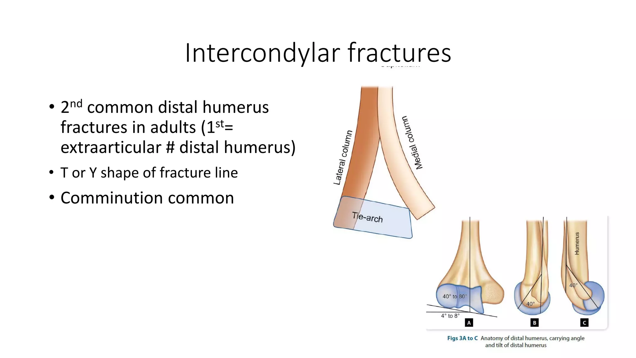 Fractures around elbow lateral condyle and intercondylar fractures | PDF