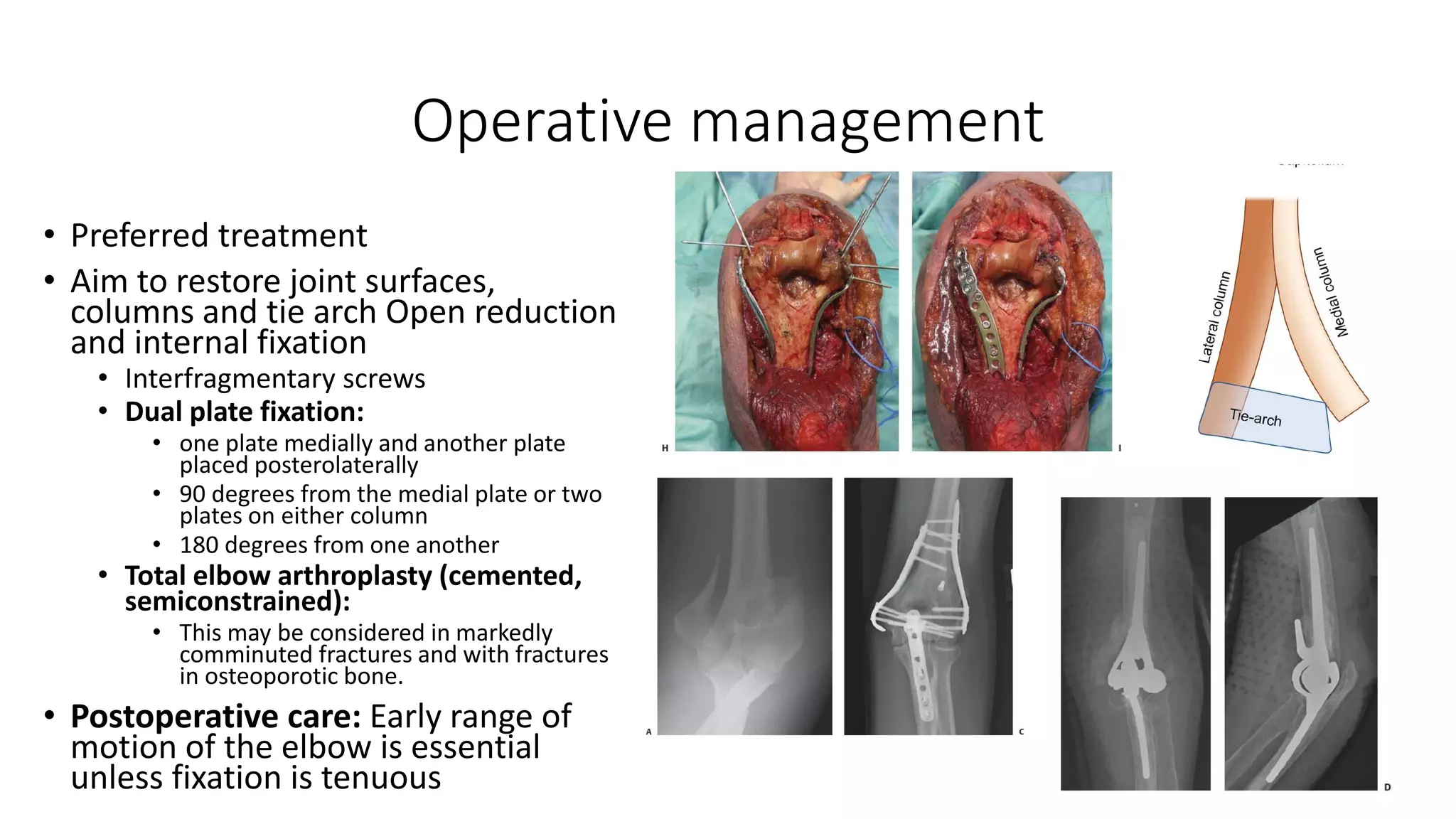 Fractures around elbow lateral condyle and intercondylar fractures | PDF