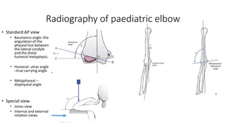 Fractures around elbow lateral condyle and intercondylar fractures | PDF