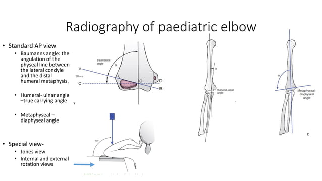 Fractures around elbow lateral condyle and intercondylar fractures | PDF