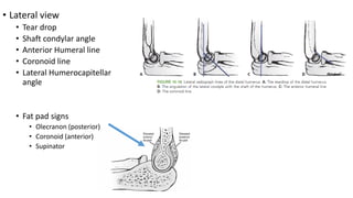 Fractures around elbow lateral condyle and intercondylar fractures | PDF
