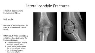 Fractures around elbow lateral condyle and intercondylar fractures | PDF