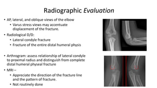 Fractures around elbow lateral condyle and intercondylar fractures | PDF