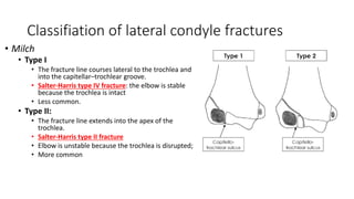 Fractures around elbow lateral condyle and intercondylar fractures | PDF