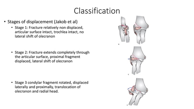 Fractures around elbow lateral condyle and intercondylar fractures | PDF