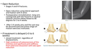 Fractures around elbow lateral condyle and intercondylar fractures | PDF