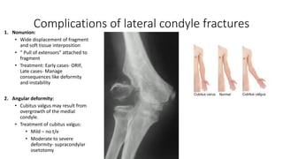 Fractures around elbow lateral condyle and intercondylar fractures | PDF