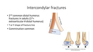 Fractures around elbow lateral condyle and intercondylar fractures | PDF
