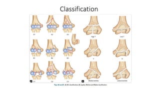 Fractures around elbow lateral condyle and intercondylar fractures | PDF