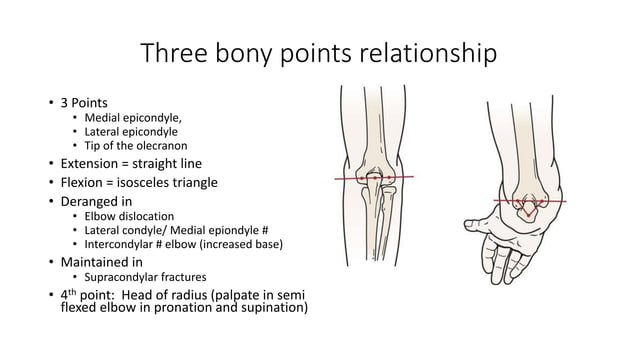 Fractures around elbow lateral condyle and intercondylar fractures | PDF