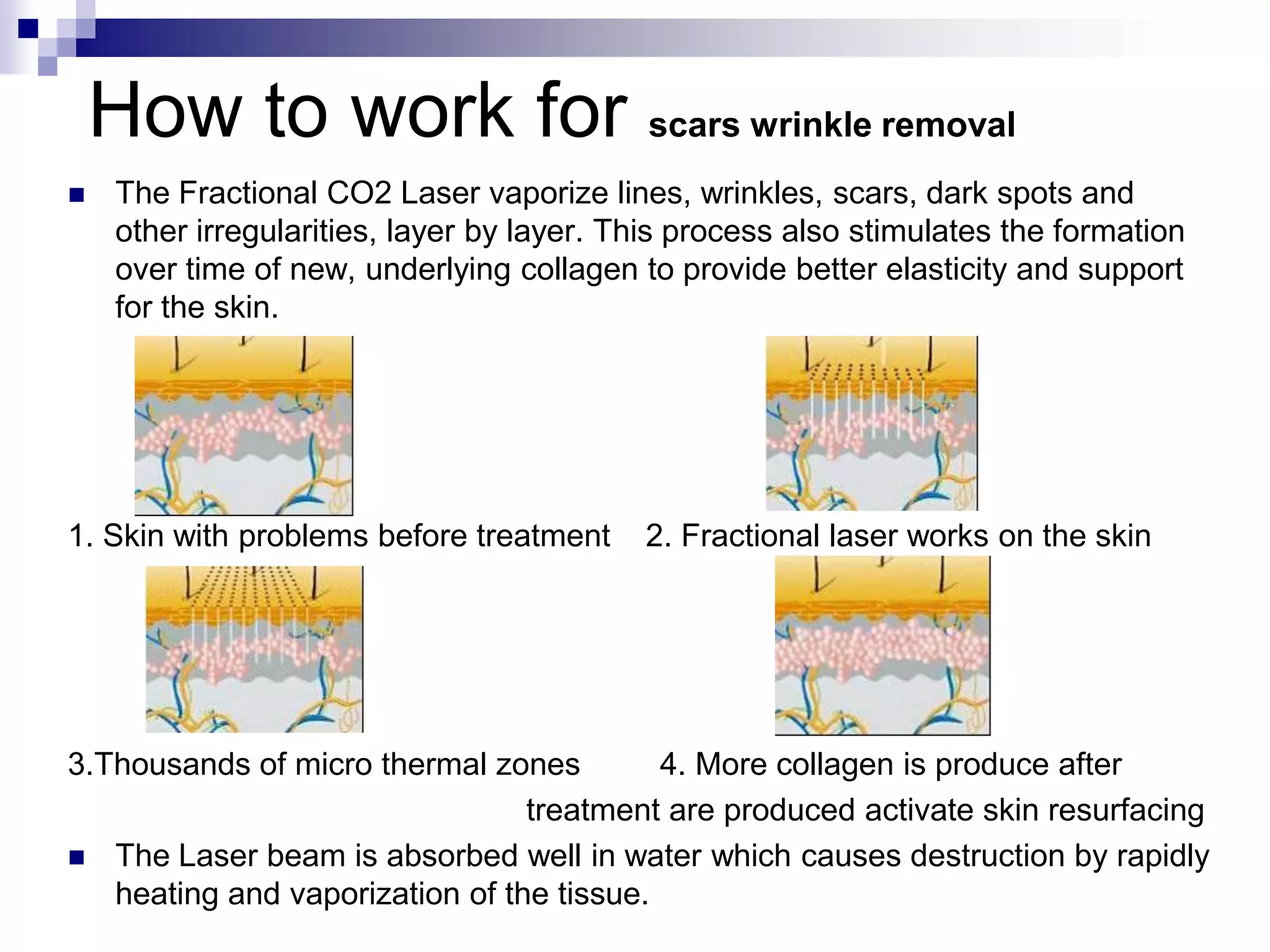 Fractional co2 laser | PDF