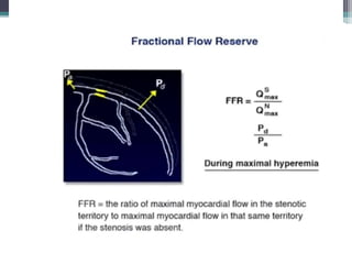 Fraction flow reserve | PPTX