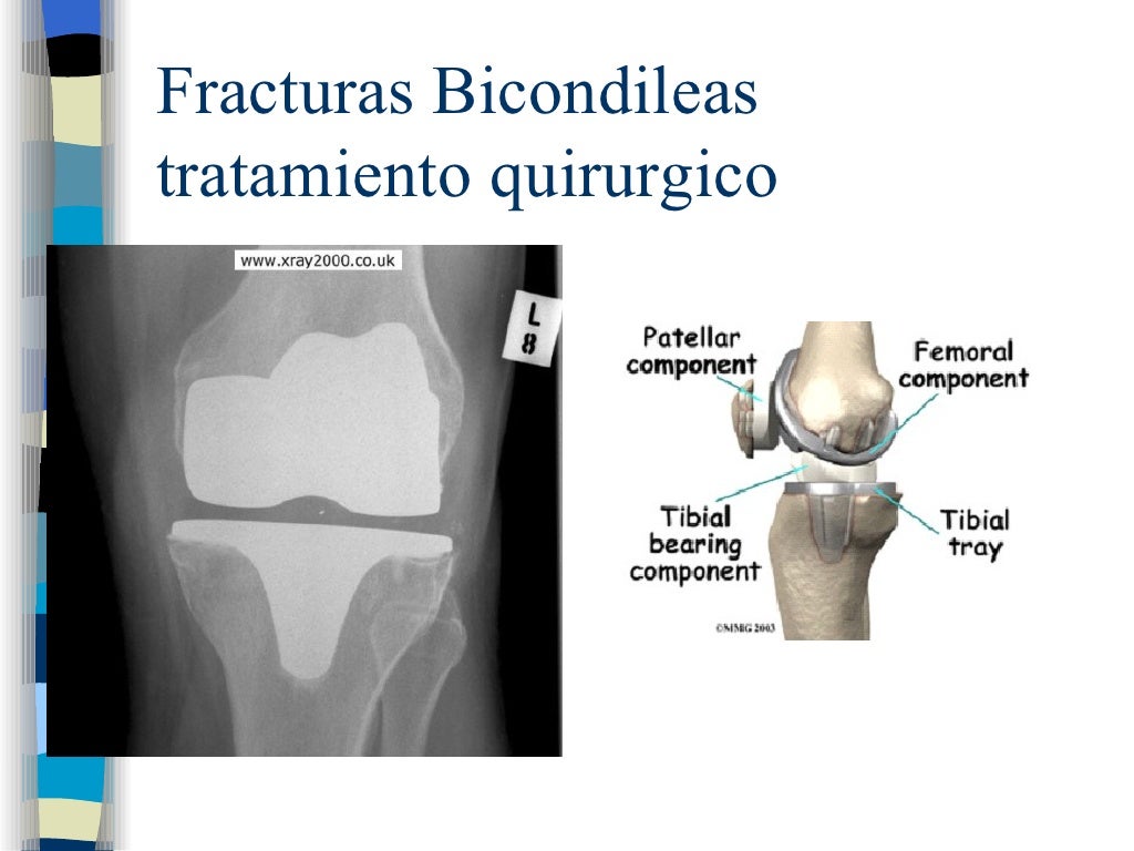Fracturas de lo condilos femorales
