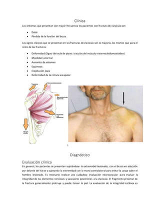 Fracturas de Clavícula | DOCX