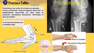 FRACTURA DE COLLES Y SMITH EN HUESO RADIO | PDF