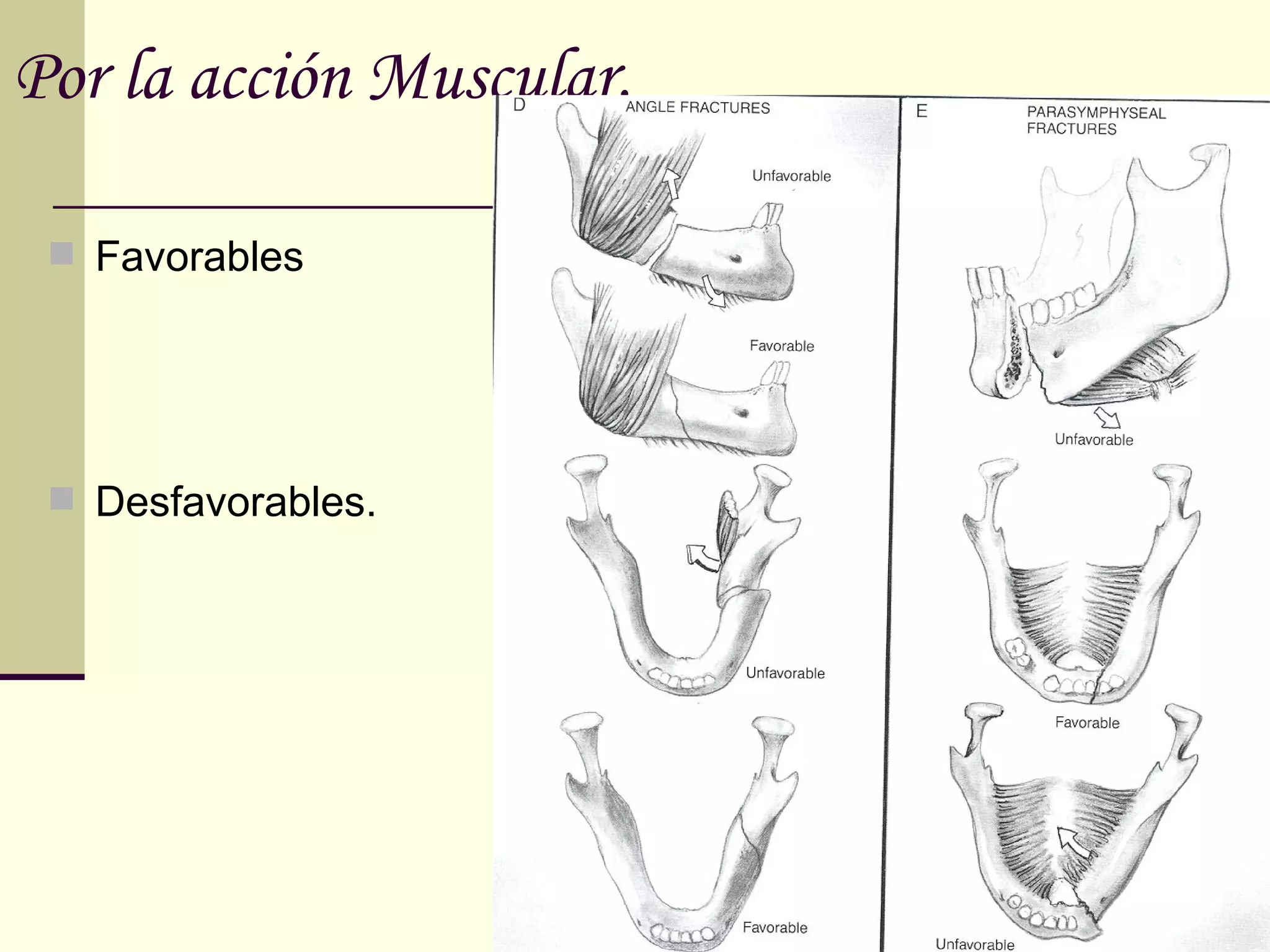 Fractura Mandibular Examen | PPT | Bone and Joint Conditions | Diseases ...