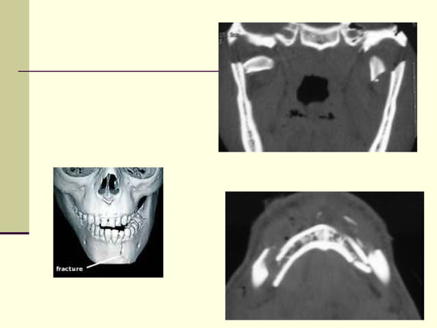 Fractura Mandibular Examen | PPT | Bone and Joint Conditions | Diseases ...