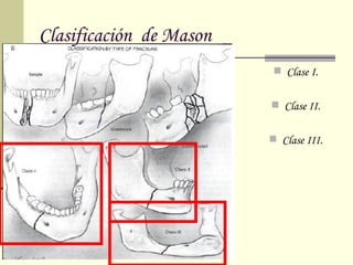 Fractura Mandibular: Medlineplus Enciclopedia Médica Illustración – IXXLIQ