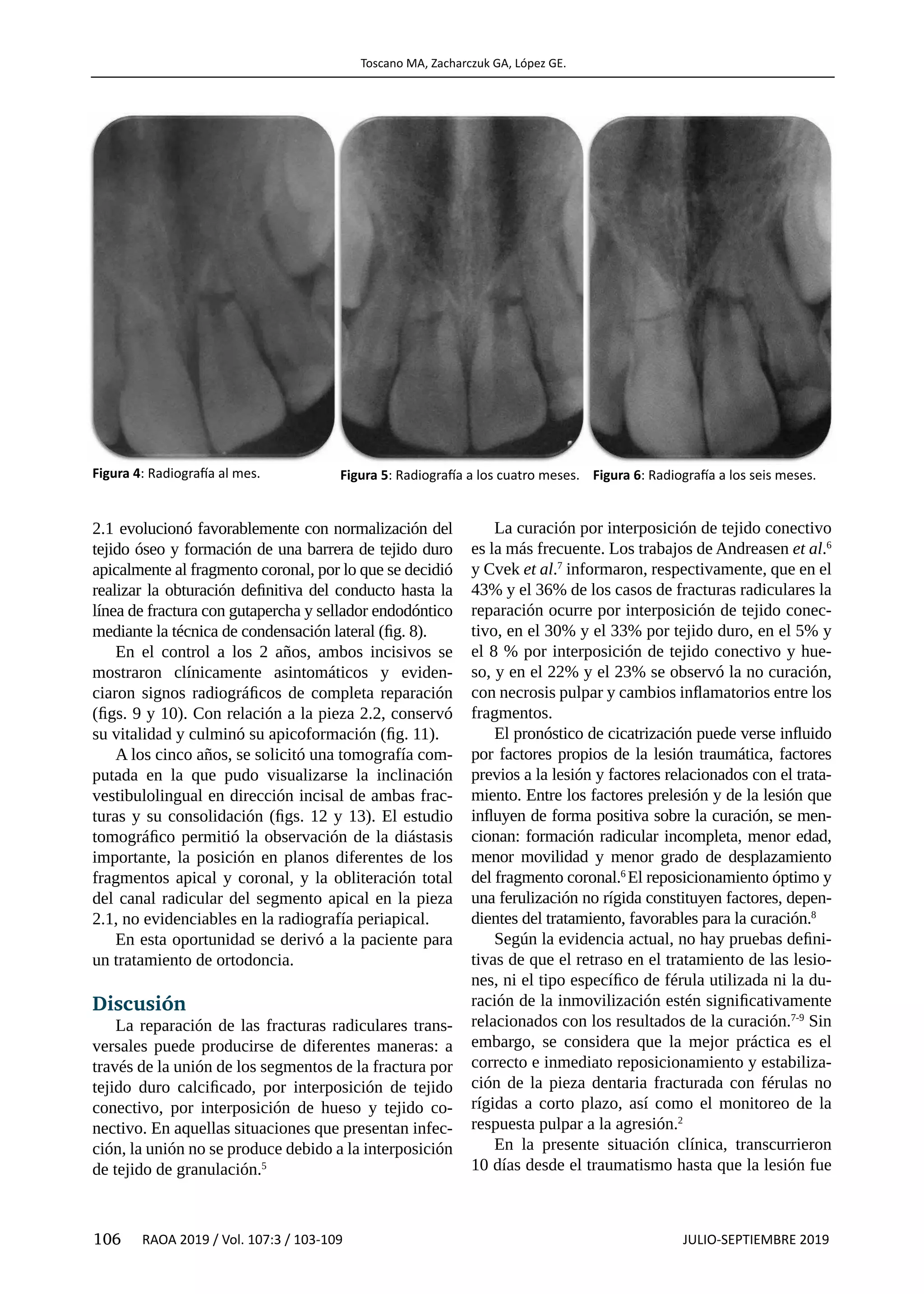 Fractura radicular-de-tercio-medio-tratamiento-y-cinco-anos-de u8hl6-zl ...
