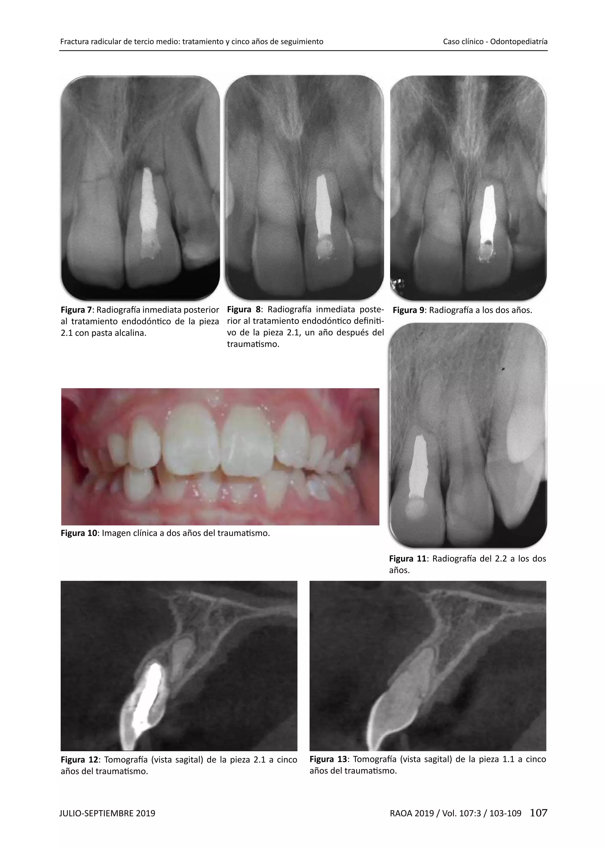 Fractura radicular-de-tercio-medio-tratamiento-y-cinco-anos-de u8hl6-zl ...