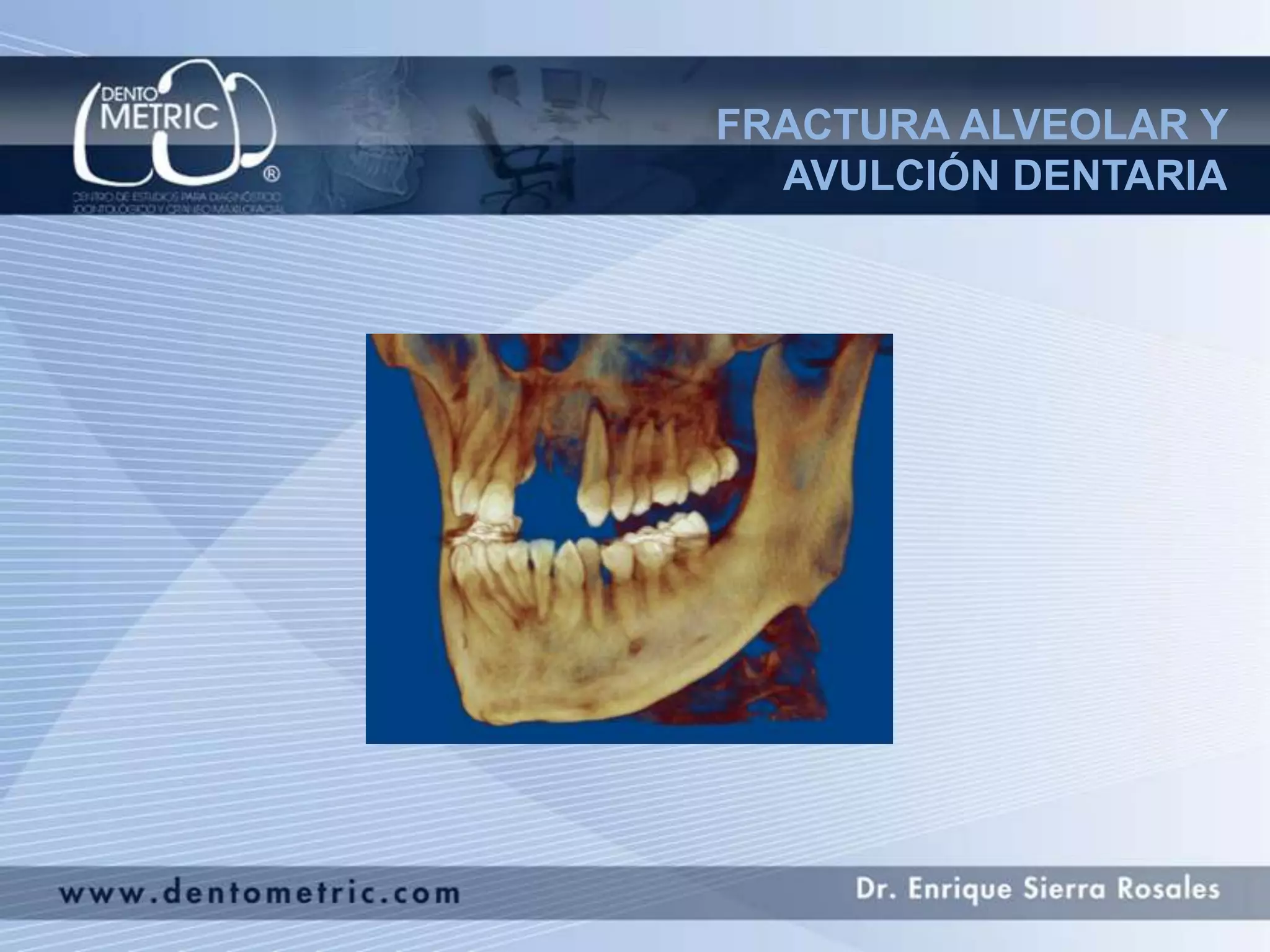 Fractura alveolar y avulcion dentaria | PPT