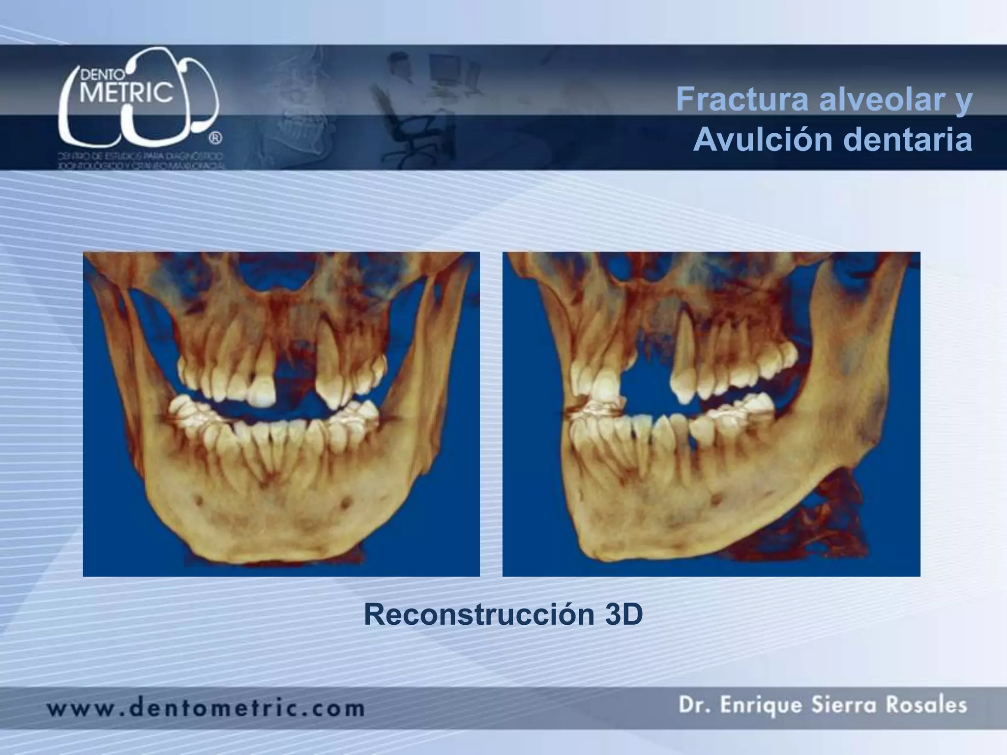 Fractura alveolar y avulcion dentaria | PPT