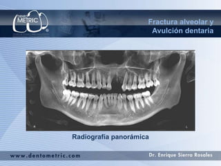 Fractura alveolar y avulcion dentaria | PPTX