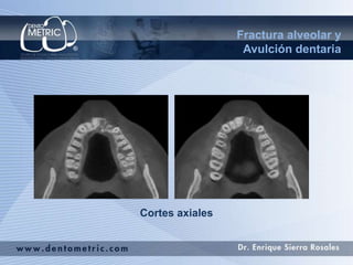 Fractura alveolar y avulcion dentaria | PPTX