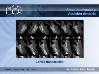 Fractura alveolar y avulcion dentaria | PPTX