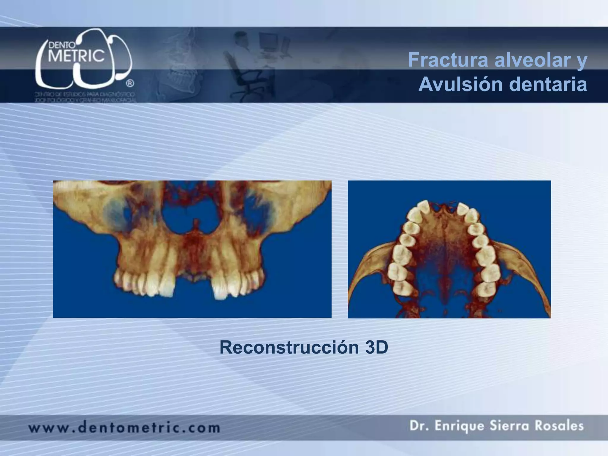 Fractura alveolar y avulsion dentaria, | PPTX | Medical Health